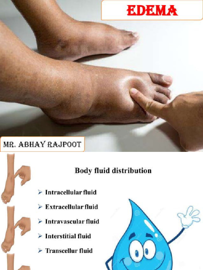 Edema | PDF