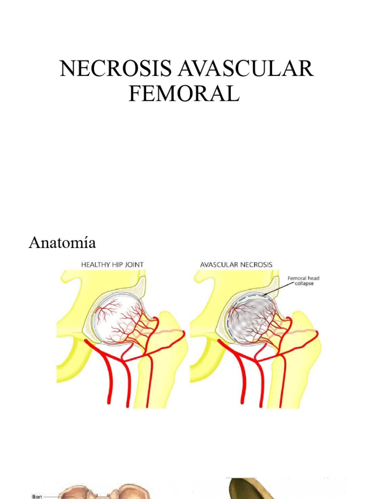 Necrosis Avascular | PDF | Hueso | Rodilla