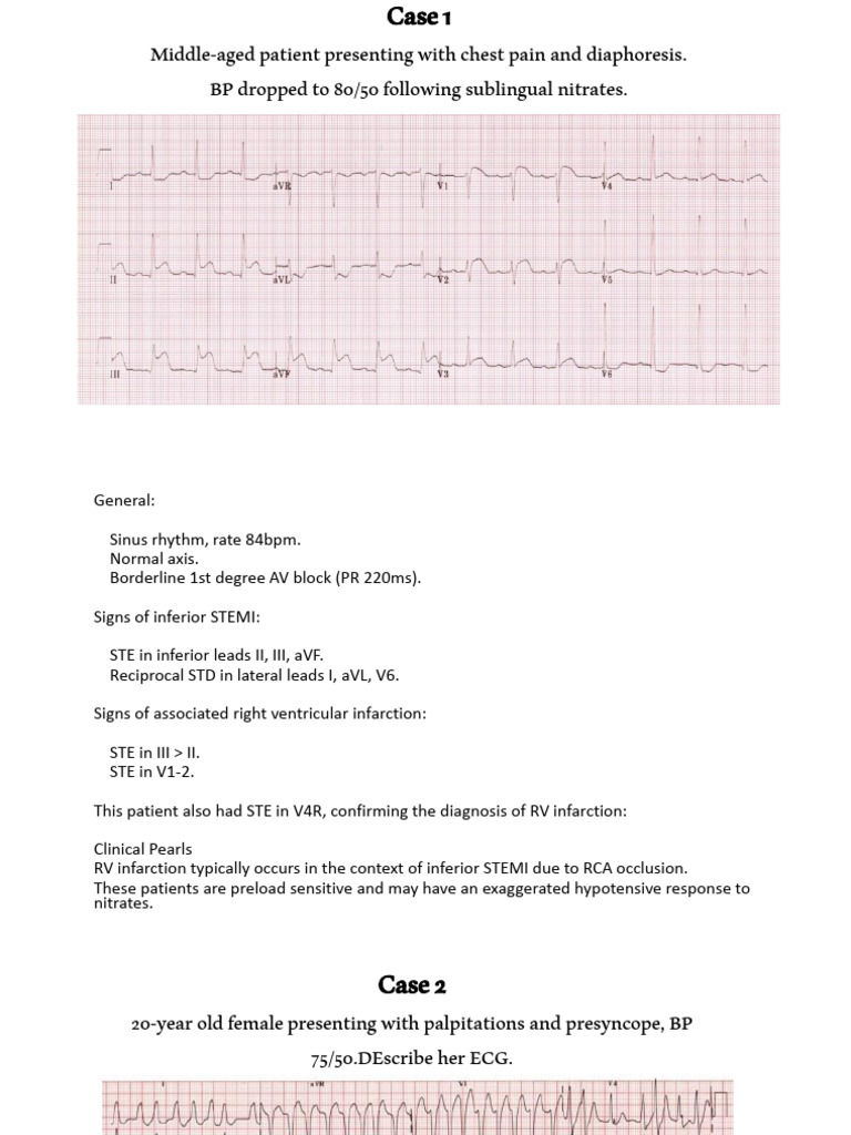 Top 100 ECG Cases | PDF | Electrocardiography | Myocardial Infarction