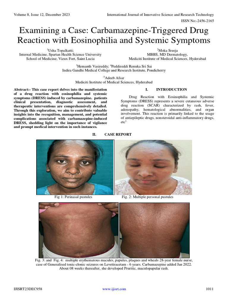 Examining A Case: Carbamazepine-Triggered Drug Reaction With ...