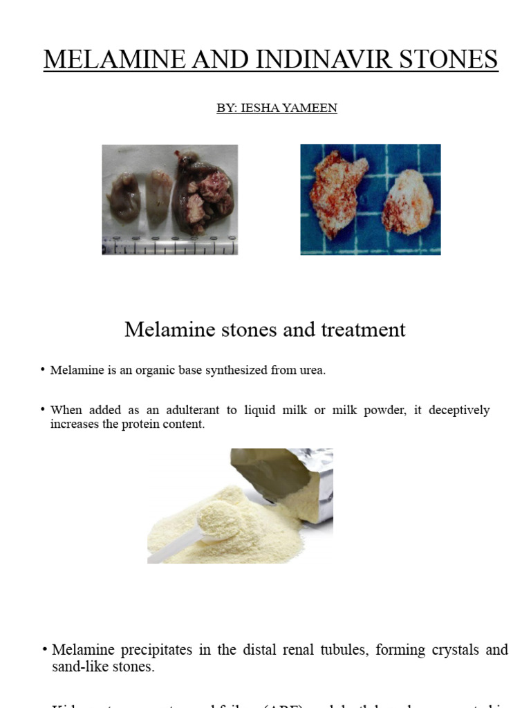 Melamine and Indinavir Stones: By: Iesha Yameen | PDF