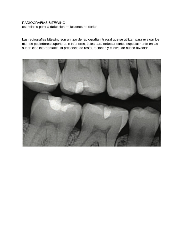 Radiografías Bitewing y Detección de Caries | PDF
