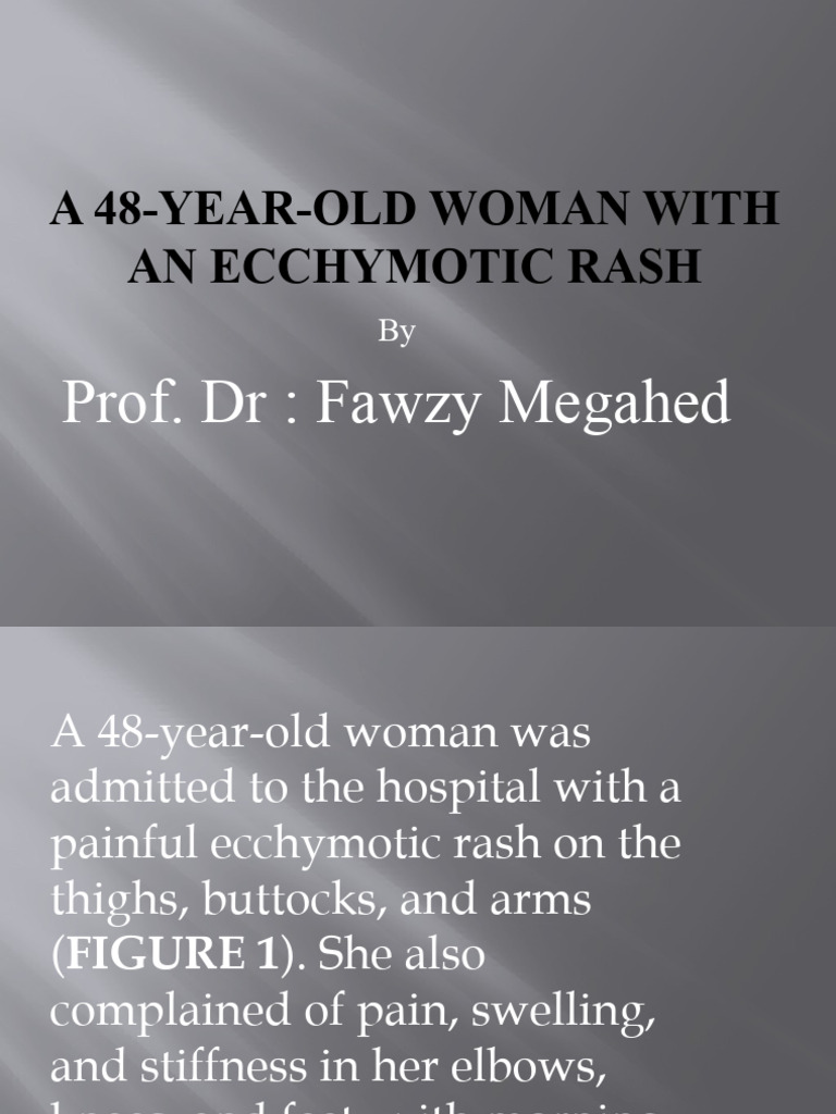 A 48-Year-Old Woman With An Ecchymotic Rash | PDF | Medical Specialties ...