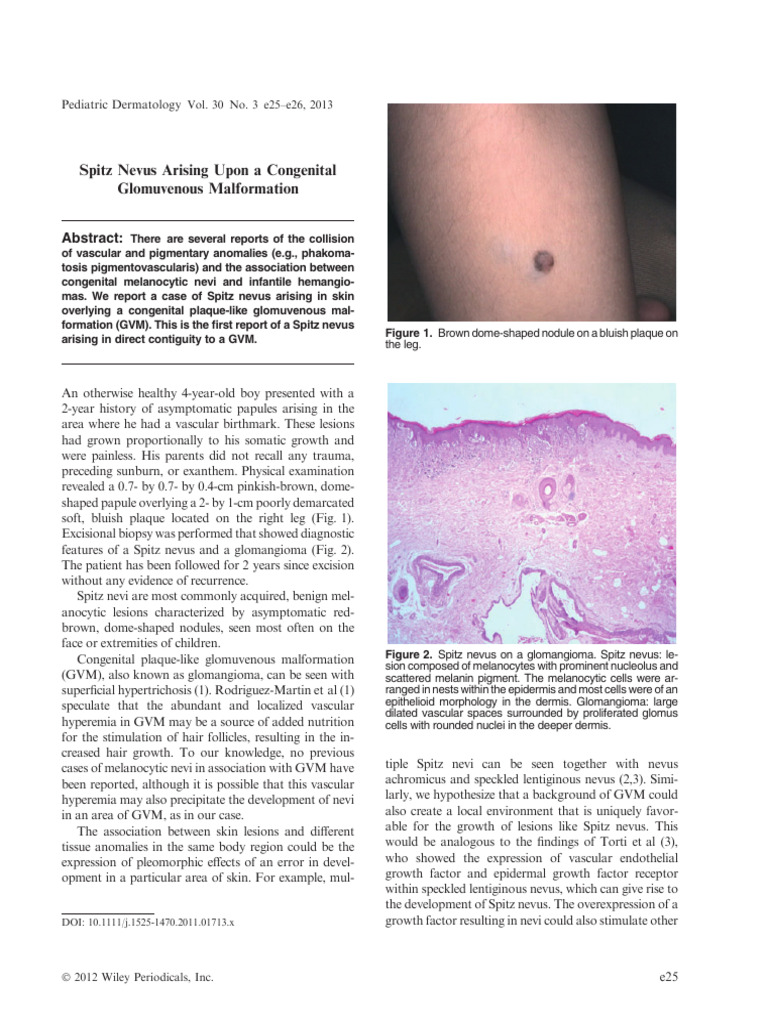 27 Spitz Nevus Arising Upon A CongenitalGlomuvenous Malformation | PDF