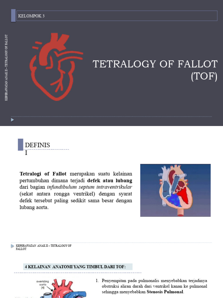 Tetralogy of Fallot Pada Anak | PDF