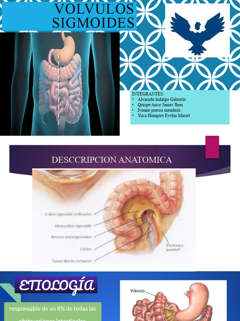 Volvulos Sigmoides | PDF | Especialidades Medicas | Medicina CLINICA