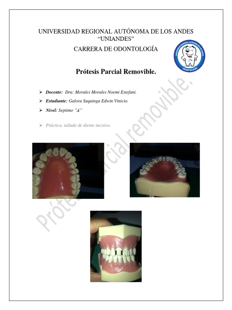 Práctica, Tallado de Diente Incisivo, PPR Galora Edwin | PDF