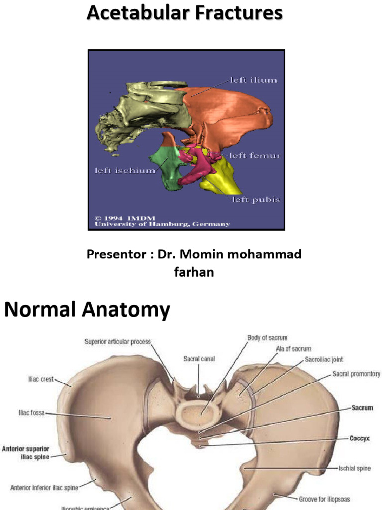 Acetabular Fracture Anatomy & Evaluation | PDF | Pelvis | Hip
