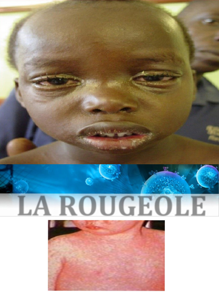 Rougeole DR Fof | PDF | Rougeole | Pneumonie