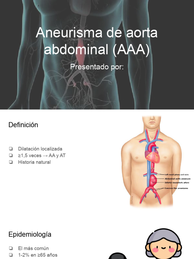 Aneurisma de Aorta Abdominal (AAA) | Descargar gratis PDF | Epidemiología | Causas de la muerte