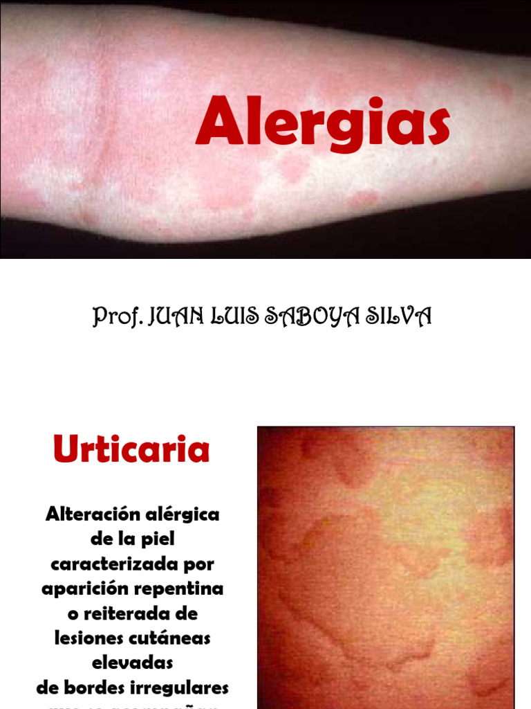 Urticaria: Causas, Síntomas y Tratamiento | PDF