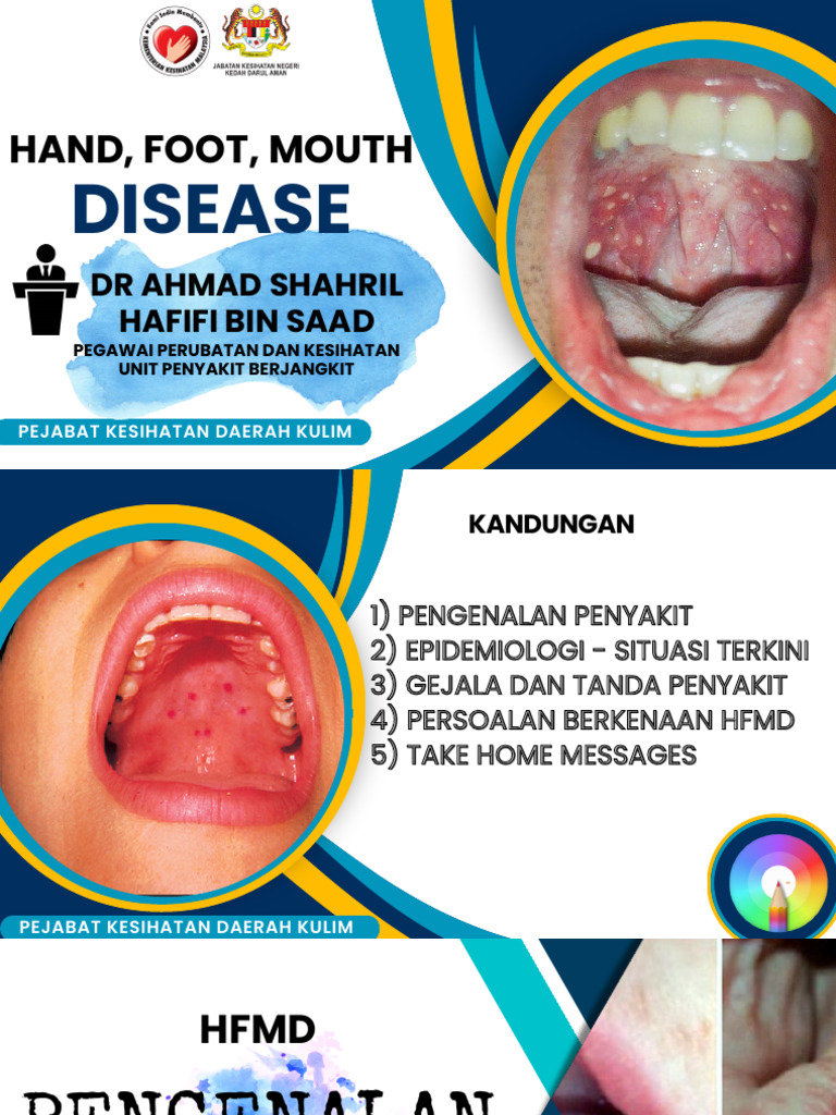 Hand, Foot, Mouth | PDF