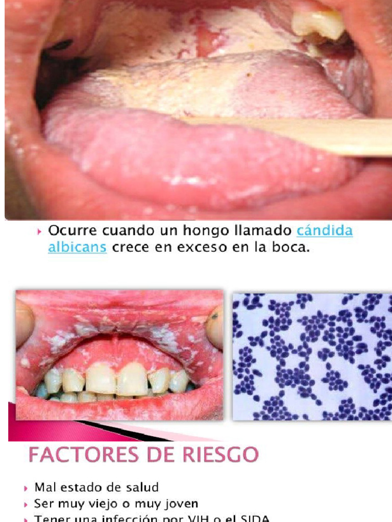 5.- Micosis oral | PDF