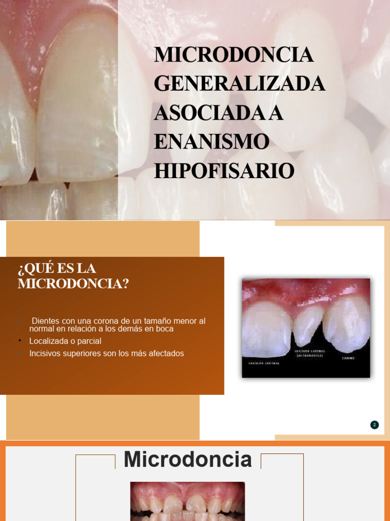 Microdoncia Generalizada Asociada A Enanismo Hipofisario | PDF ...