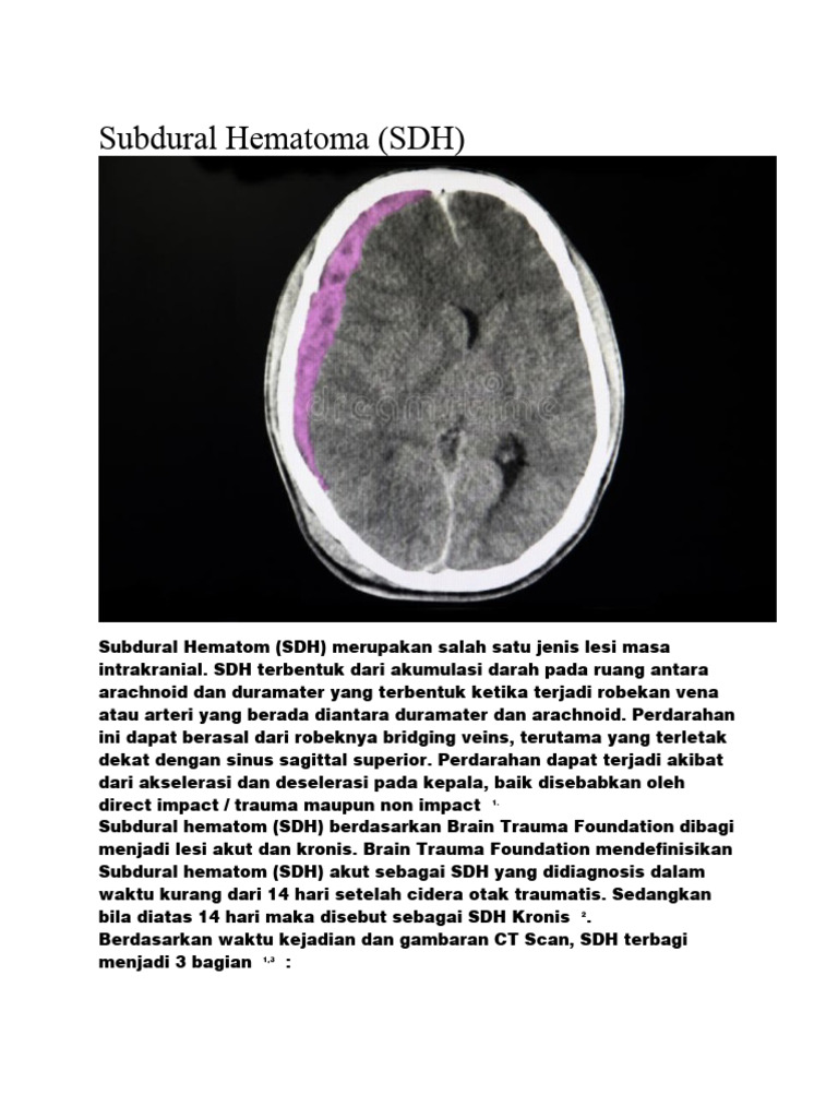 Subdural Hematoma | PDF