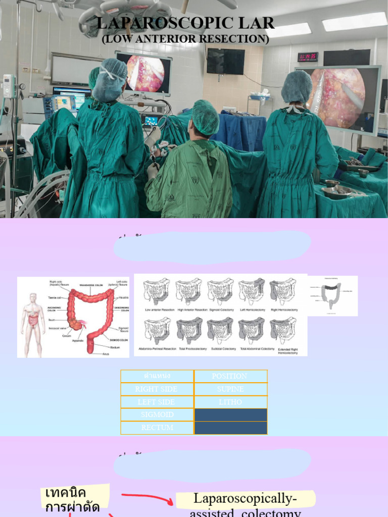 (Low Anterior Resection) : Laparoscopic Lar | PDF