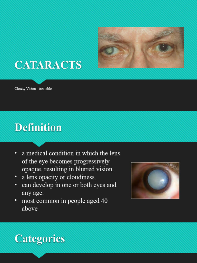 Cataracts | PDF | Cataract | Glasses