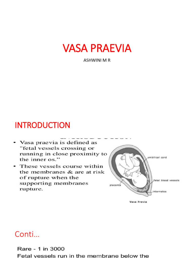 Vasa Praevia | PDF