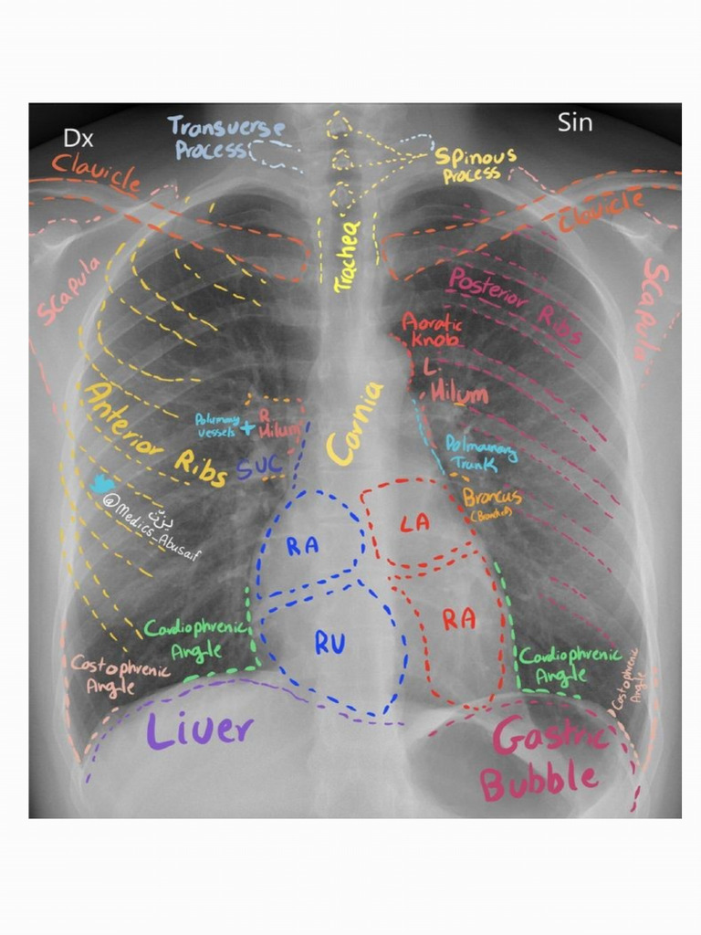 Radiografía de tórax _240106_115943 | PDF