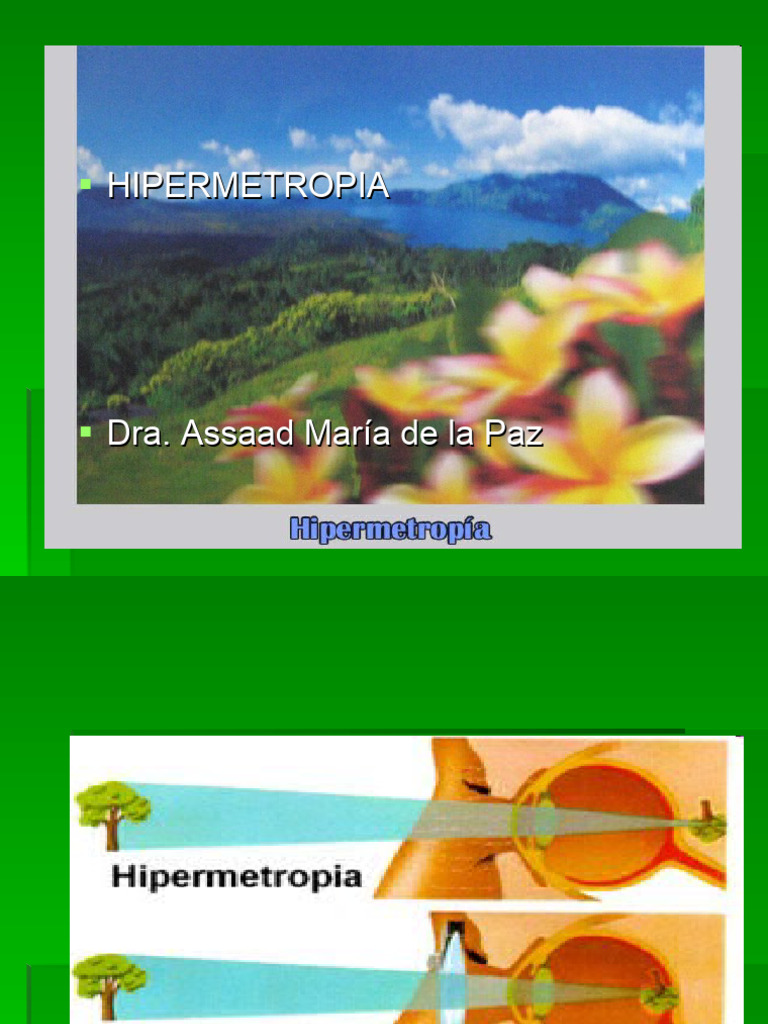 Guía Completa sobre Hipermetropía | PDF