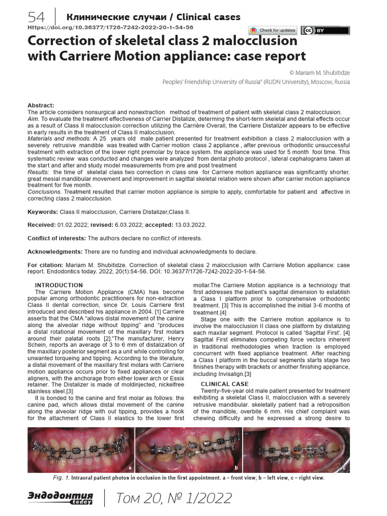 Class II Malocclusion Correction with Carriere Motion | PDF
