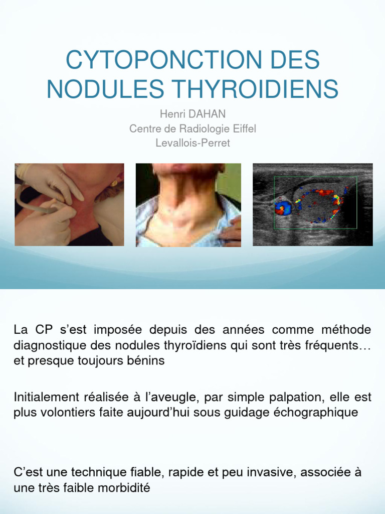 Nodules Thyroïdiens | PDF