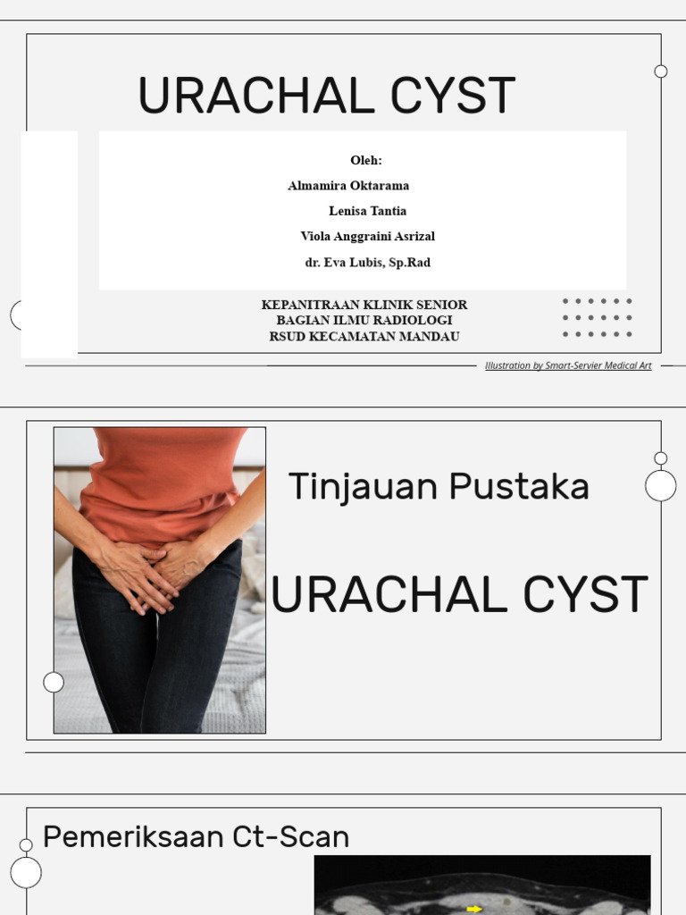 Uracal Cyst | PDF | Medical Diagnosis | Cardiovascular Diseases