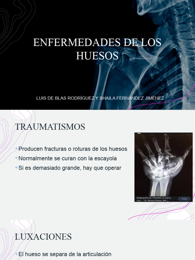Enfermedades de Los Huesos | PDF
