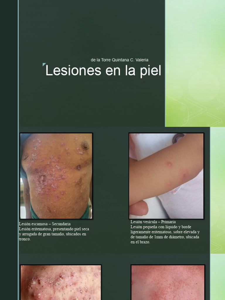 Lesiones de La Piel | PDF