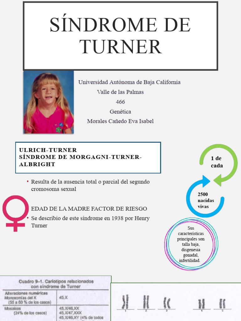Sindrome de Turner | PDF | Medicina | Especialidades Medicas