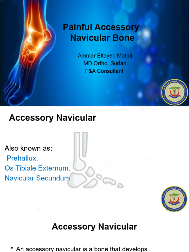 Painfull Accessory Navicular Bone | PDF | Foot | Surgery