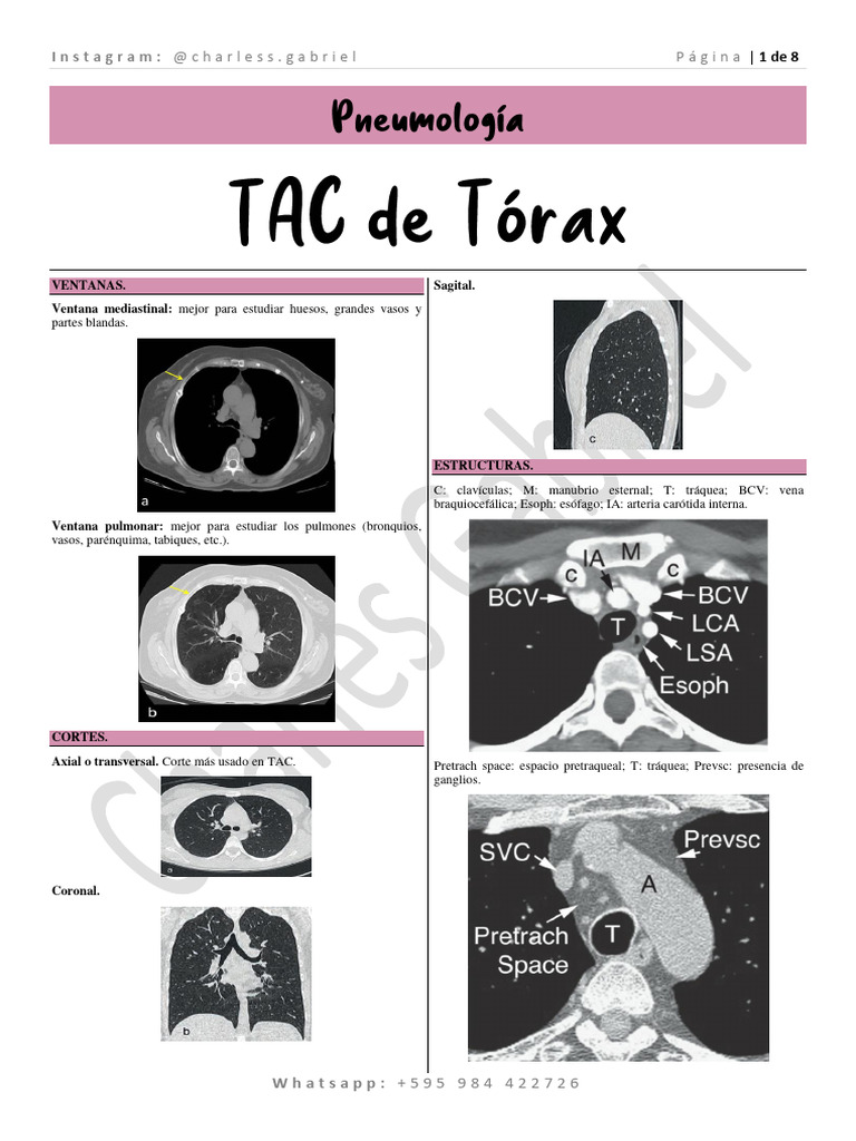 2 - TAC de Tórax | Descargar gratis PDF | Pulmón | Ct Scan