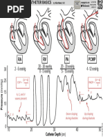 ICU One Pager External Pacemakers v11 | PDF | Artificial Cardiac ...