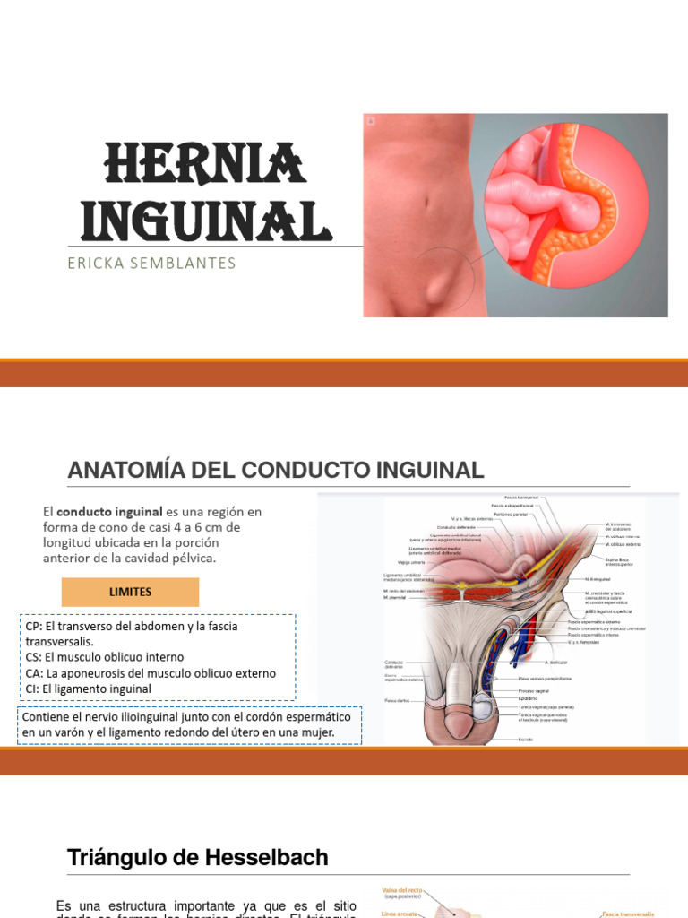 Hernia Inguinal | PDF