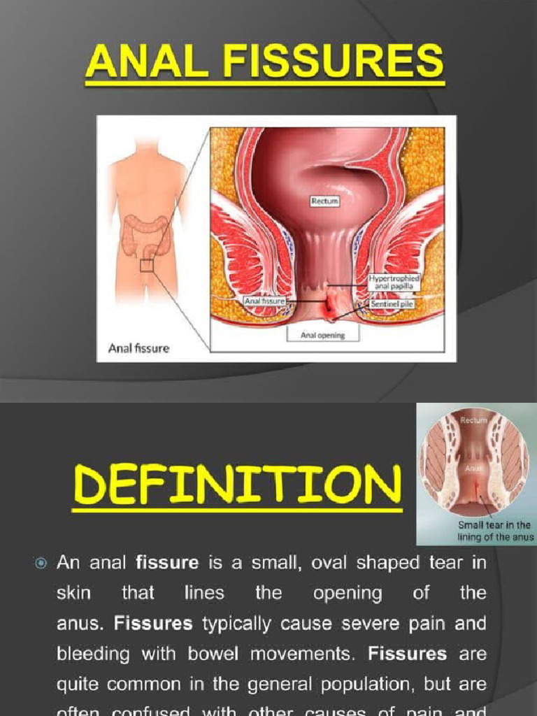 ANAL FISSURE AND FISTULA | PDF
