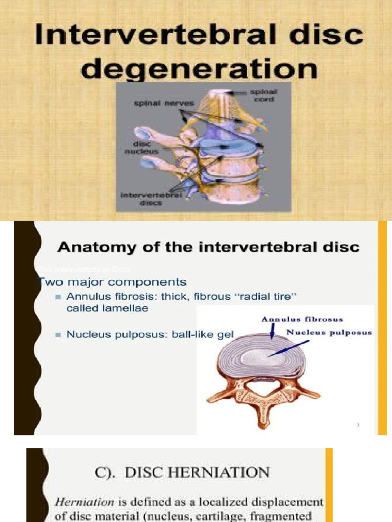 Degenerative Disc Disease | PDF