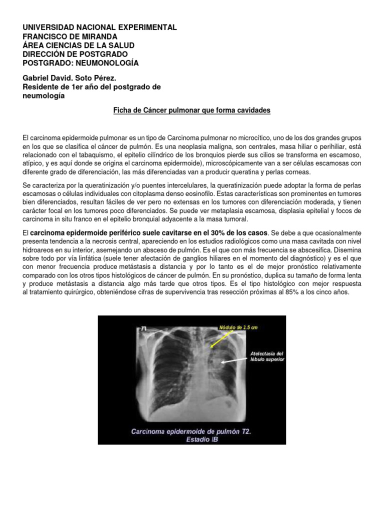 Carcinoma Epidermoide Cavidad Pdf