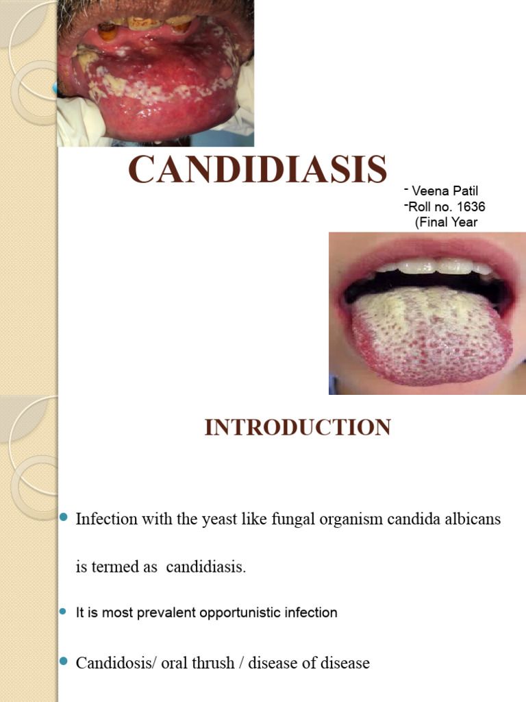 Candidiasis Final Final | PDF