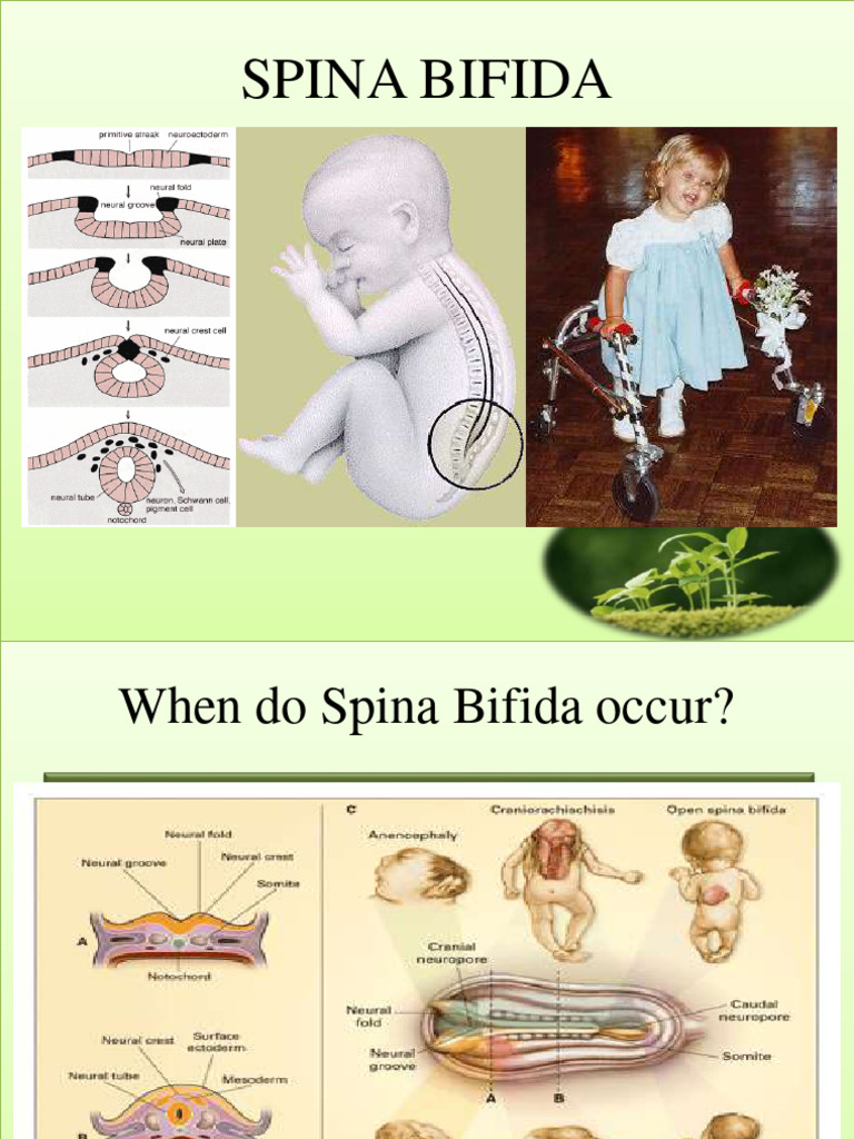 15.spina Bifida | PDF | Vertebral Column | Neurological Disorders