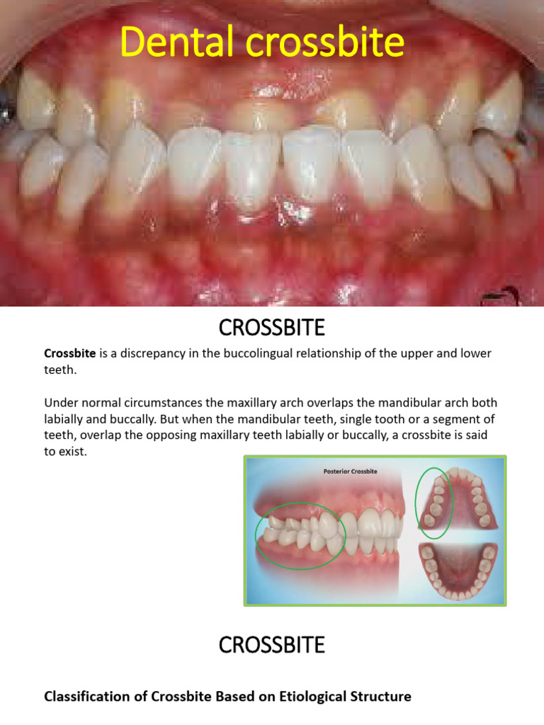 Cross Bite | PDF | Face | Animal Anatomy