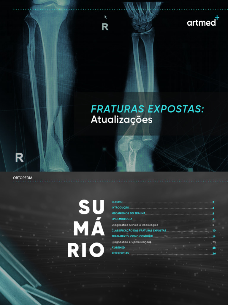 Fratura Exposta | PDF | Cirurgia ortopédica | Imunidade (Medicina)