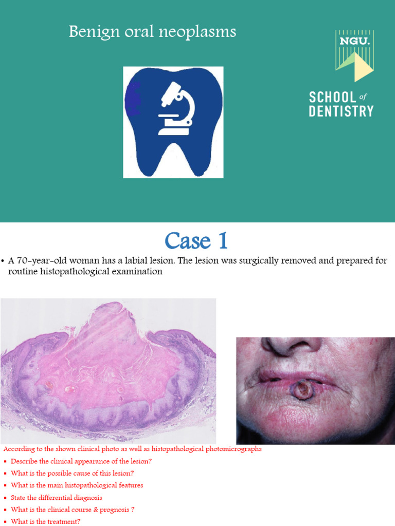 Week (11) Benign Tumors | PDF | Histopathology | Neoplasms