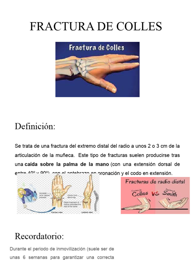 Fractura de Colles | PDF | Mano | Síndrome del túnel carpiano