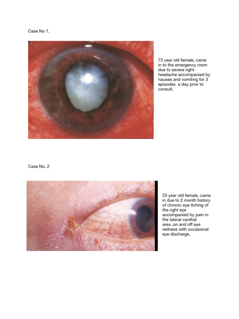 Cases 9.6.22 | PDF | Visual Acuity | Human Eye