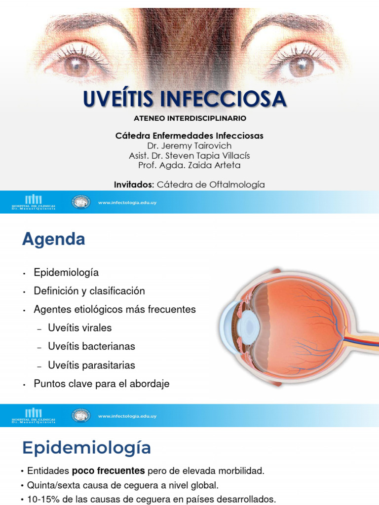 Uveitis Infecciosa Ateneo | PDF | Tuberculosis | Especialidades Medicas