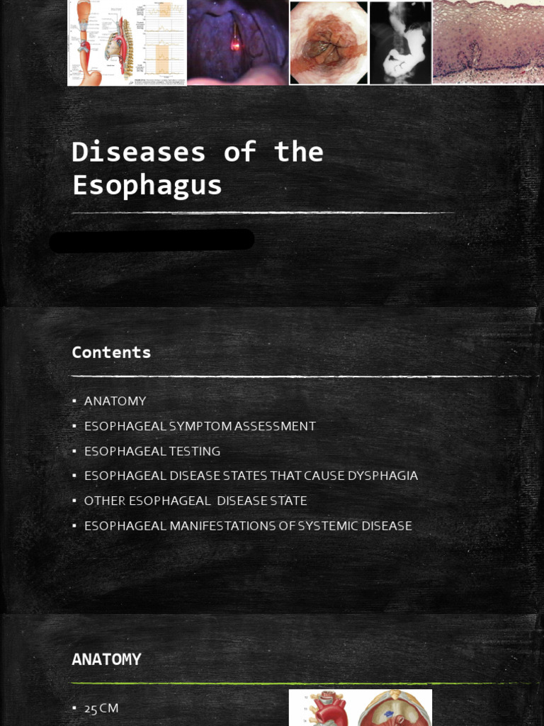 Diseases of esophagus | PDF | Gastroesophageal Reflux Disease | Esophagus