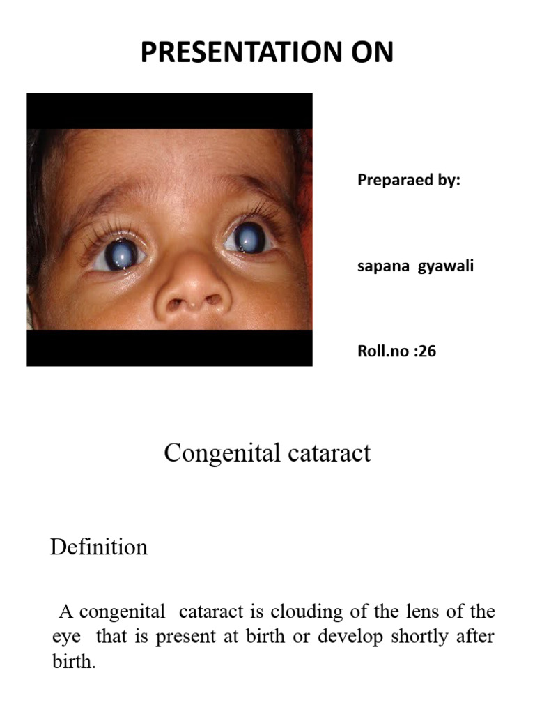 Congenital Cataract Overview | PDF | Cataract | Human Eye