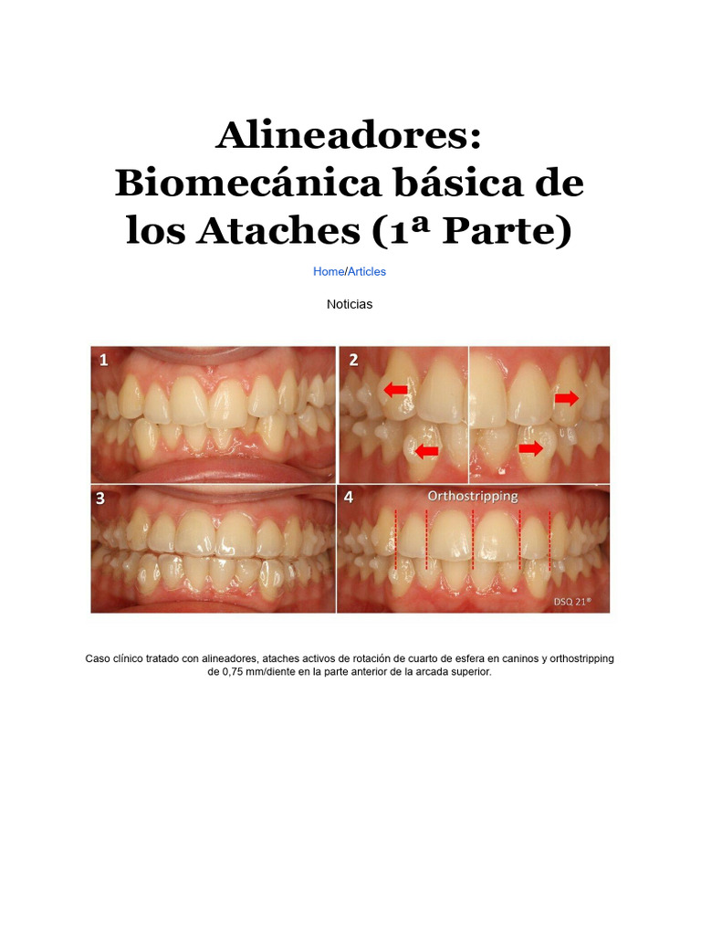 Biomecánica de Ataches en Alineadores | PDF | Ortodoncia | Fuerza