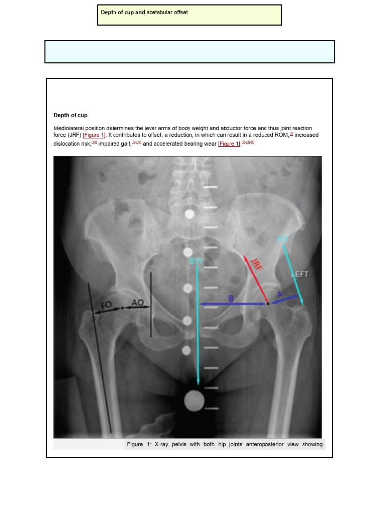 Depth of Cup and Acetabular Offset | PDF | Musculoskeletal System