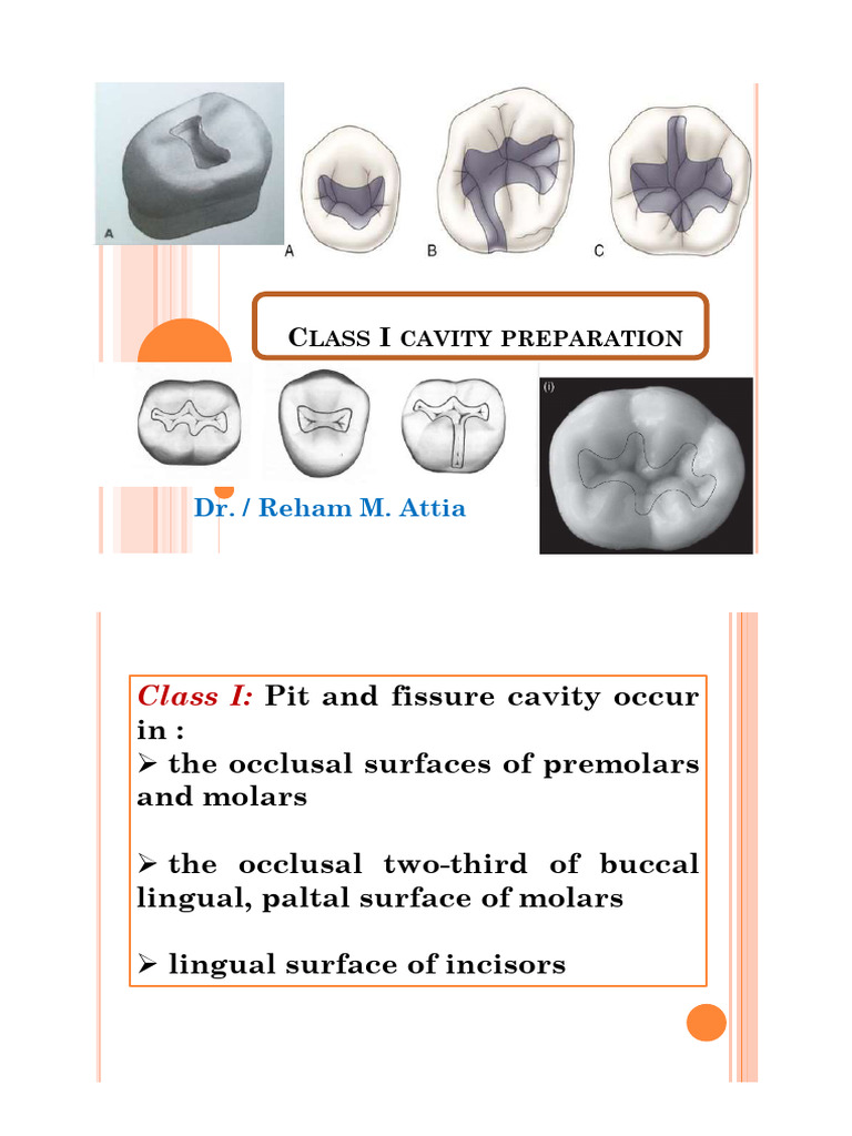Class 1 | PDF | Tooth Enamel | Dentin